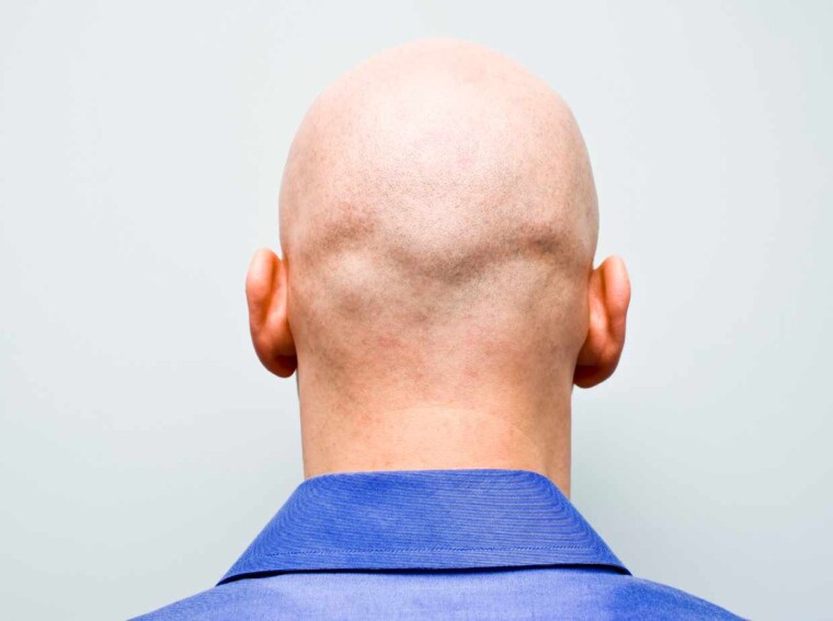 Is It Normal To Have A Dent In The Back Of Your Head Discovering Skull Is It Normal To Have A Dent In The Back Of Your Head Discovering Skull
